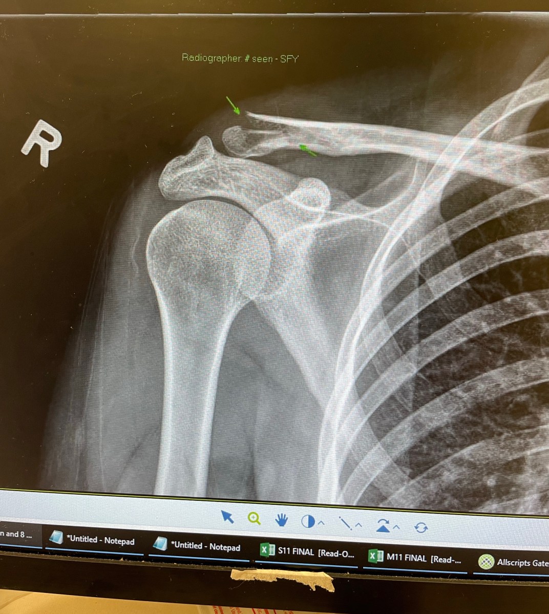 I Broke My Collarbone! What Is A Distal Clavicle Fracture? – Melodie ...